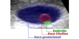 O que é saco gestacional? - Almanaque dos Pais