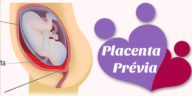 O que é Placenta Previa - em vídeo - Almanaque dos Pais